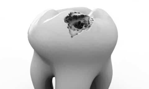 How to Fix a Hole in Your Tooth Without a Dentist?
